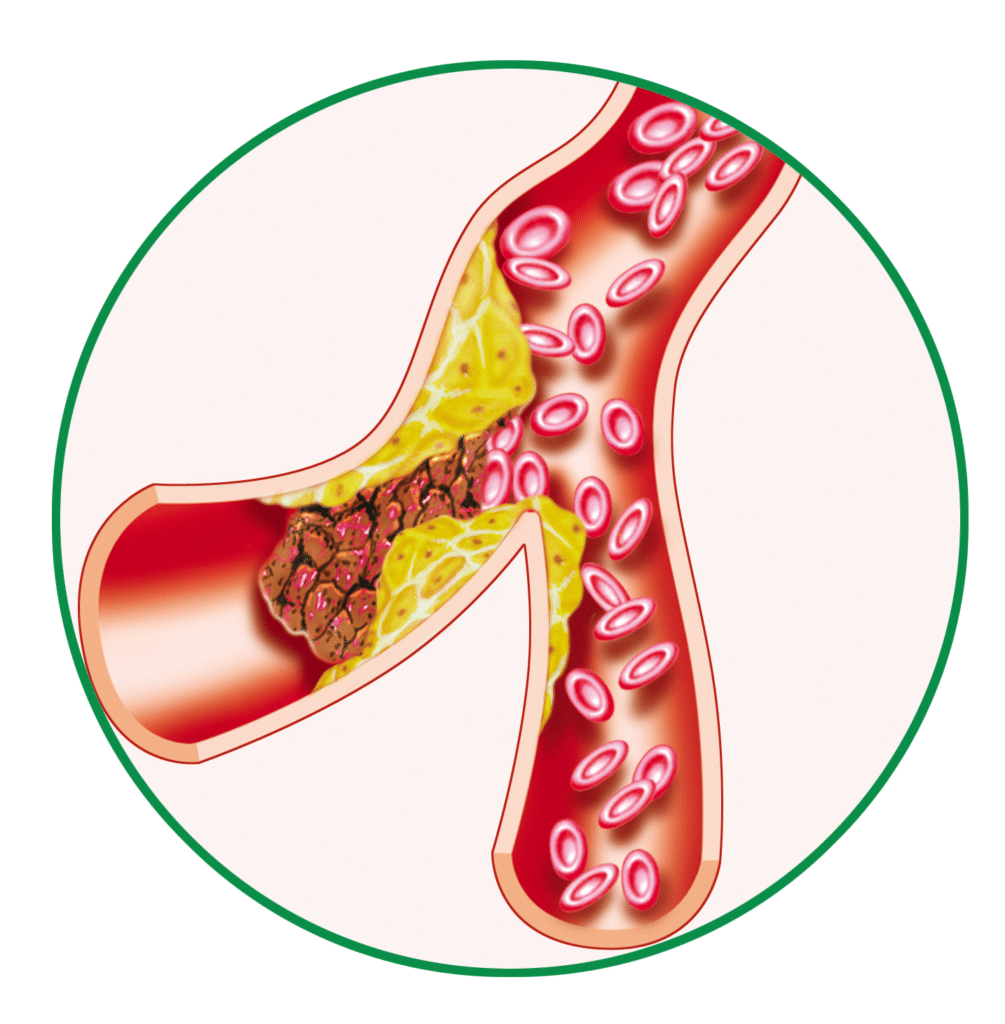 Steckbrief: Thrombose - Angehörige Pflegen