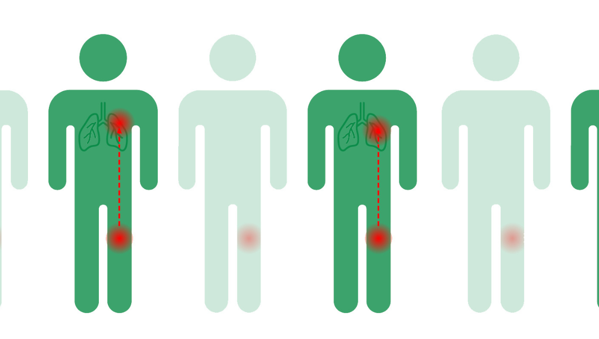 Blutstau im Bein: Was Sie über Thrombose wissen sollten - Angehörige ...